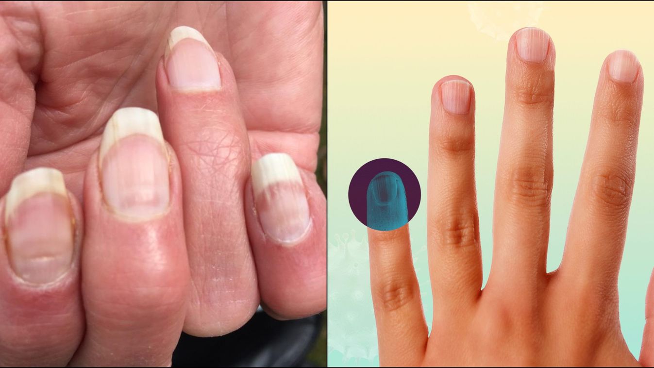 A körmöd elárulja, ha már átestél a koronavíruson? Vess egy pillantást ...